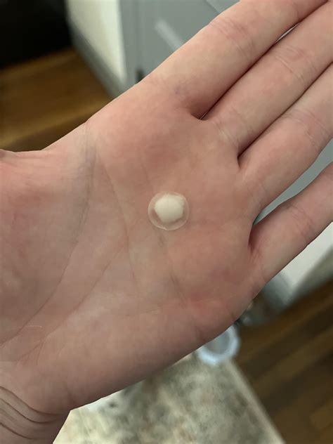 From A Nodular Acne Cyst 💀 Miscellaneous Rskincareaddiction