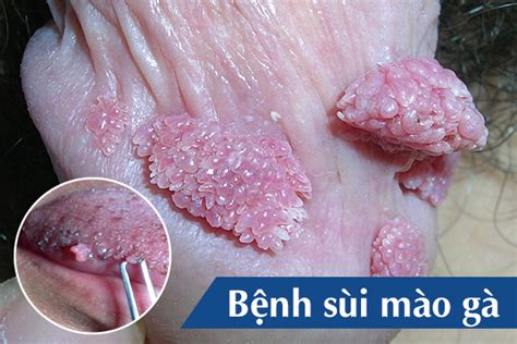 SÙi MÀo GÀ Ở Nam DẤu HiỆu NguyÊn NhÂn VÀ CÁch ĐiỀu TrỊ