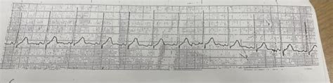Solved What Is The Av Ratio Of The Ecg Strip