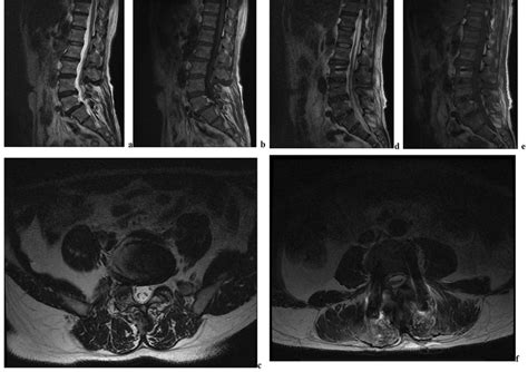 The Ventrodorsal Combined Type Ssh A Preoperative T2 Weighted