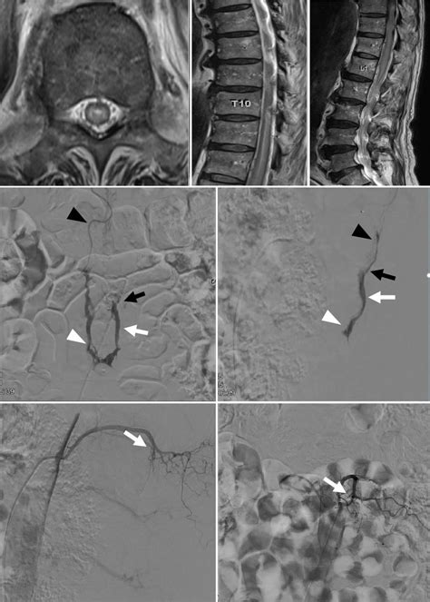Figure Spinal Magnetic Resonance Imaging And Angiogram A C On Download Scientific Diagram