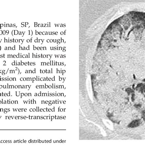 X Ray Computed Tomography Of The Thorax Showing Diffuse Patchy