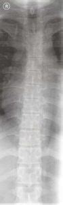 Ce4rt Radiographic Positioning Of The Thoracic Spine For X Ray Techs