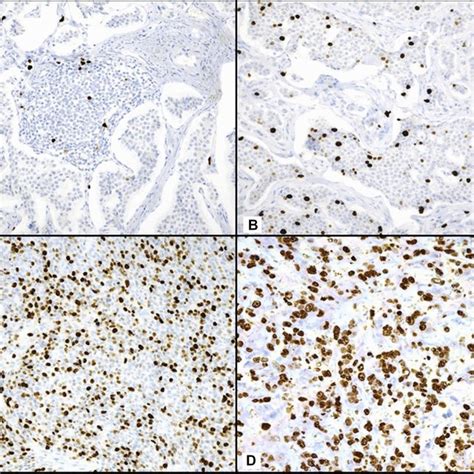 Ki67 Labeling Index Distribution In Neuroendocrine Tumors 20 In