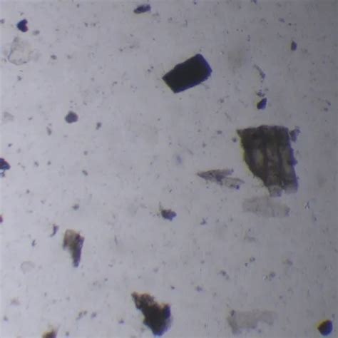 Balantidium Coli Slide Balantidium Coli In Urine Sediment Report Of A