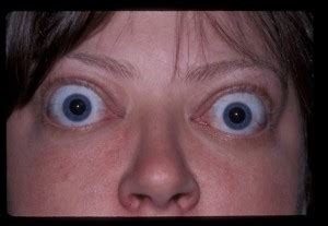 Surgery For Thyroid Eye Disease Orbital Decompression Surgery Before