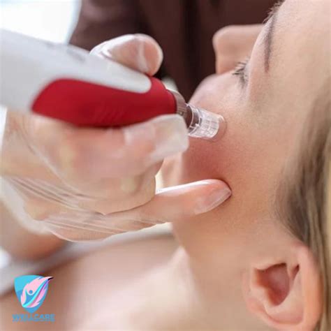 Effective Micro Needling Acne Scar Treatment Get Smooth Clear Skin