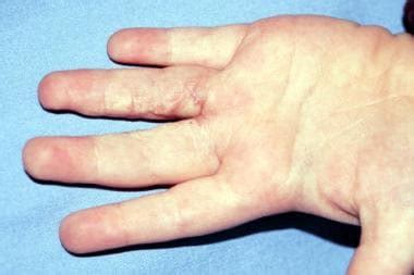 Syndactyly Treatment And Management Approach Considerations Medical