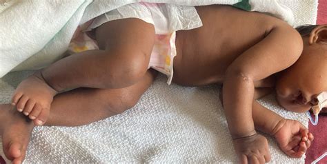 An Unusual Case Of Pseudohypoaldosteronism Coexisting With Cystic Fibrosis Bmj Case Reports