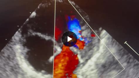 Congenital Problems 🫀 A Newborn Was Referred After A Loud Murmur Was