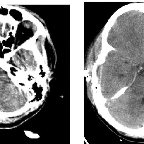 Antero Posterior Rt Temporal Hematoma Evacuated Surgically In Patient Download Scientific