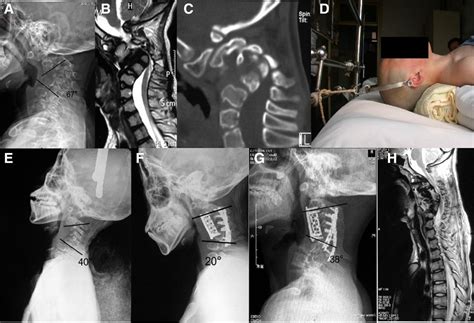 Frontiers Effect Of Cervical Suspensory Traction In The Treatment Of