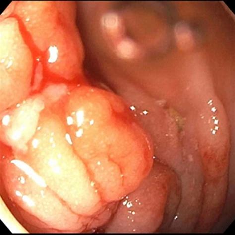 Repeat Colonoscopy Showing Congested Mucosa In The Rectosigmoid Colon Download Scientific
