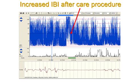 Aeeg脳波トレンド『治療処置後のibiの増加』アイ・エム・アイ（株）