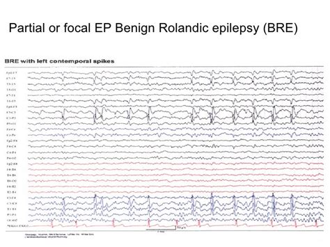 Epilepsy