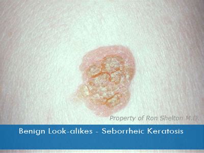 Seborrheic Keratosis Removal And Treatment In Nyc Dr Ron Shelton