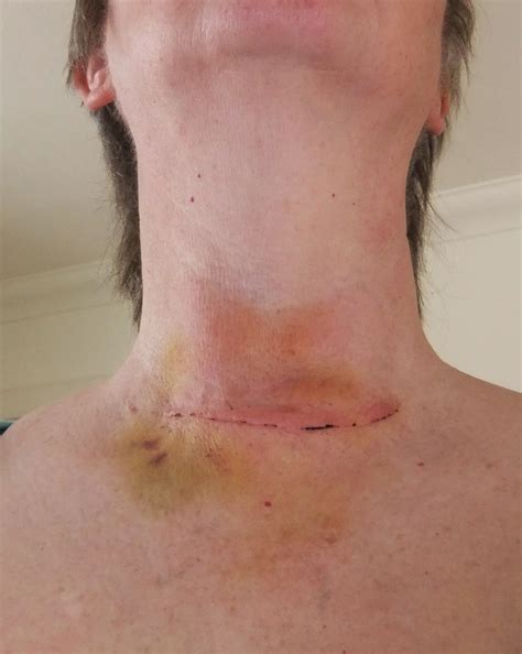Partial Thyroidectomy Before And After Photos Partial Thyroidectomy