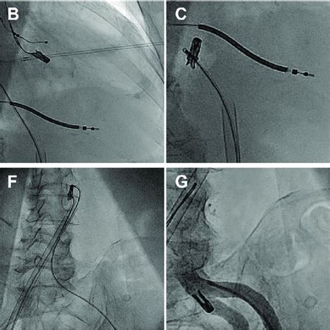 Procedural Steps Shown On Fluoroscopy Download Scientific Diagram