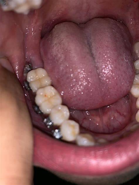 5 Days Post Wisdom Tooth Extraction Referring To The Photo Is This Normal Like I Can See A