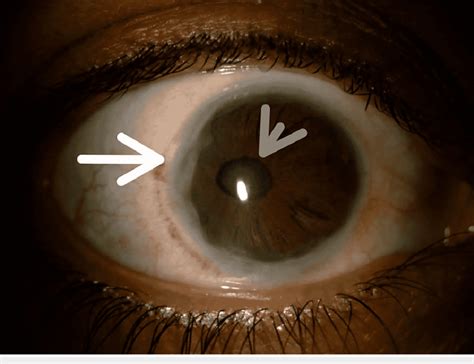 Anterior Segment Photograph Of The Right Eye Showing Posterior Download Scientific Diagram