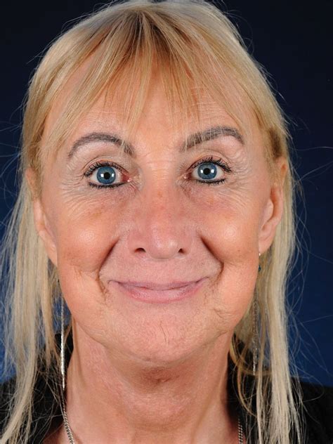 2pass Clinic Worldwide Reference In Naturally Feminizing Your Face