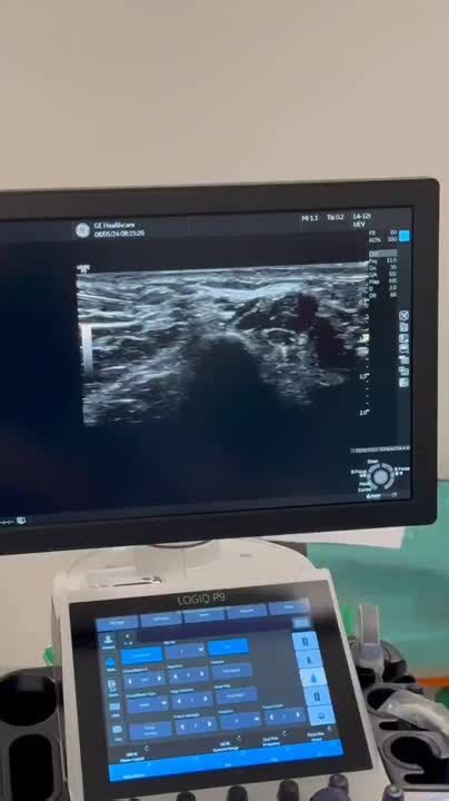 Marina Banović Md On Linkedin Ulnar Nerve Hydrodissection It Can Be Seen At The Beginning Of