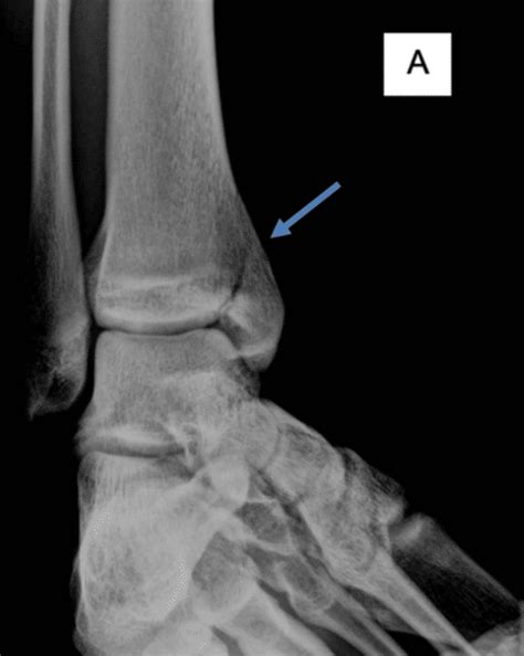 Medial Malleolus Fracture