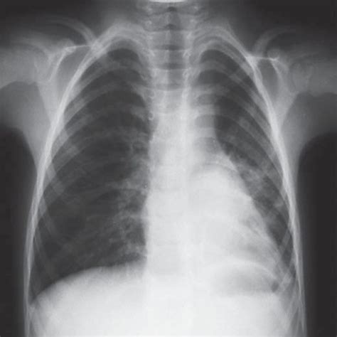 Pdf Plastic Bronchitis An Unusual Cause Of Atelectasis