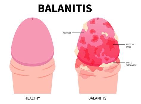 Balanitis Pictures