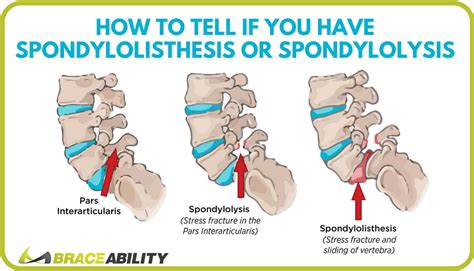 Spondylolysis Vs Spondylolisthesis Spondylolysis Vs Spondylolisthesis