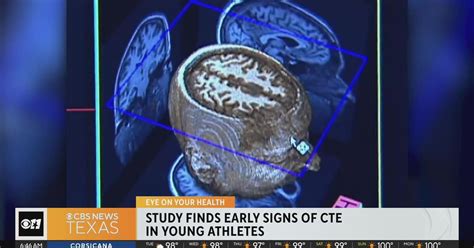 Study Finds Early Signs Of Cte In Young Athletes Cbs Texas