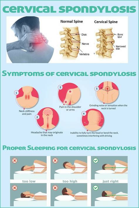 Cervical Spondylosis Symptoms Management And Treatment Artofit