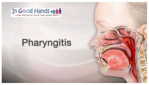 Treatment For Pharyngitis Tonsillitis And Sinusitis