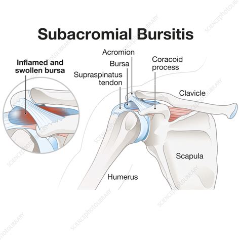 Subacromial Bursitis Of The Shoulder Illustration Stock Image F0431312 Science Photo Library