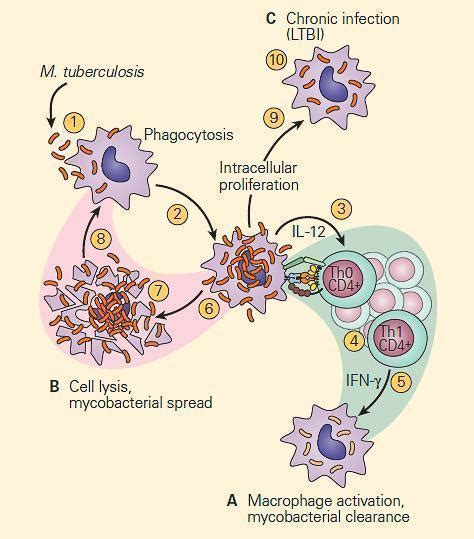 Tubercle Tuberculosis
