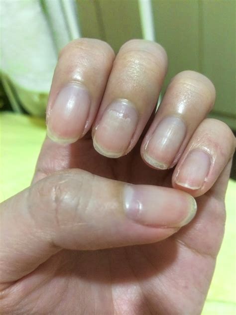 The Dettol Diaries Peeling Fingernails After Hfmd