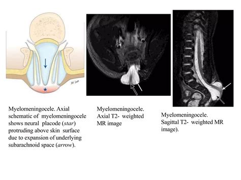 Imaging In Spinal Dysraphism Pptx