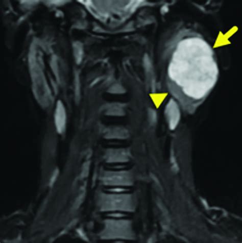 Pleomorphic Adenoma Mri