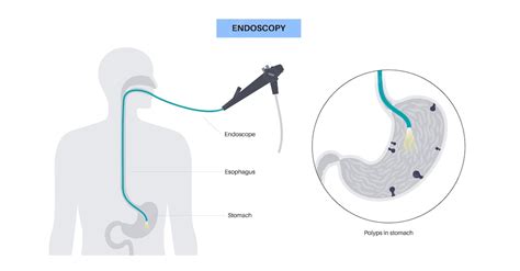 Premium Vector Gastroscopy Procedure Gastroenterologist Uses A