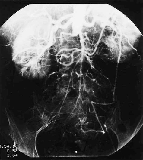 Necrotizing Vasculitis Semantic Scholar