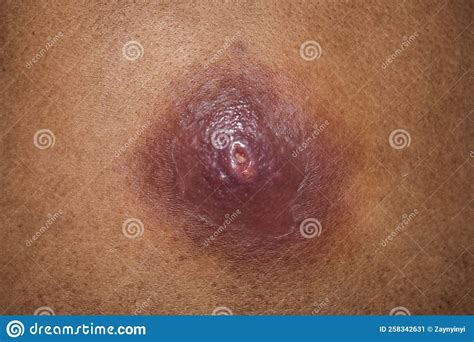 Large Carbuncle Or Abscess At The Back Of Asian Female Patient Stock