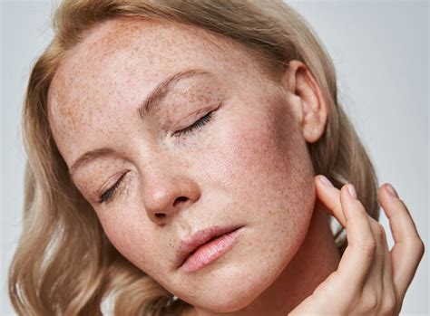 Freckles Vs Sun Spots Whats The Difference Plated ® Skin Science