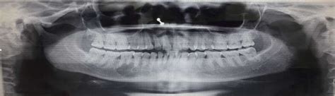 Opg Showing Multilocular Radiolucency Download Scientific Diagram