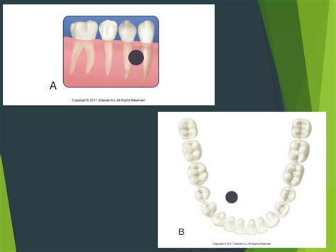 Chapter 21 Occlusal And Localization Technique Ppt