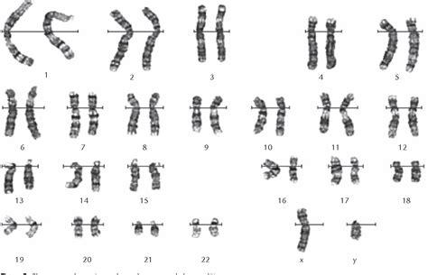 Figure 1 From Extraskeletal Osteochondroma Of The Foot Semantic Scholar