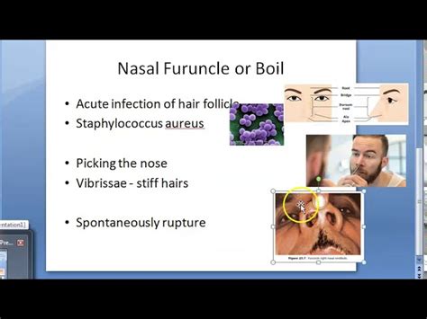 Nasal Furunculosis Diagnosis In Otorhinolaryngology Onerci 2009
