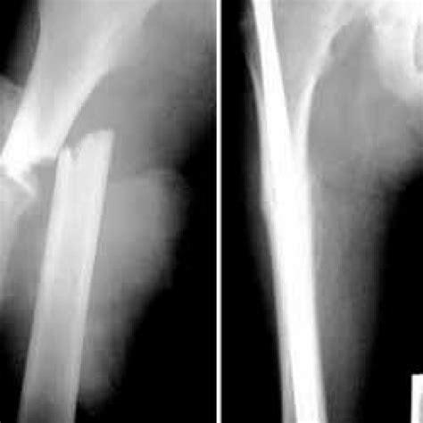 The Fixion System The Nail With The Insertion Handle And The Inflating