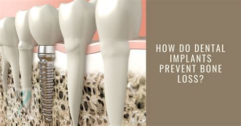 How Do Dental Implants Prevent Bone Loss