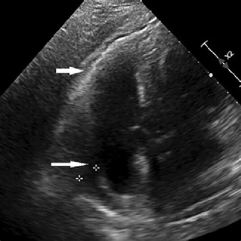 A Fluid With A Fibrin Layer Behind The Right Atrium And The Right
