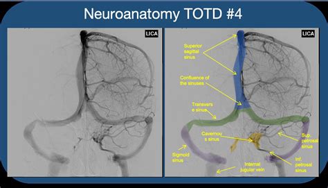 Cavernous Sinus Sagittal